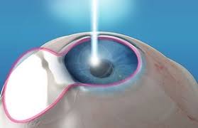 Refractive Surgery