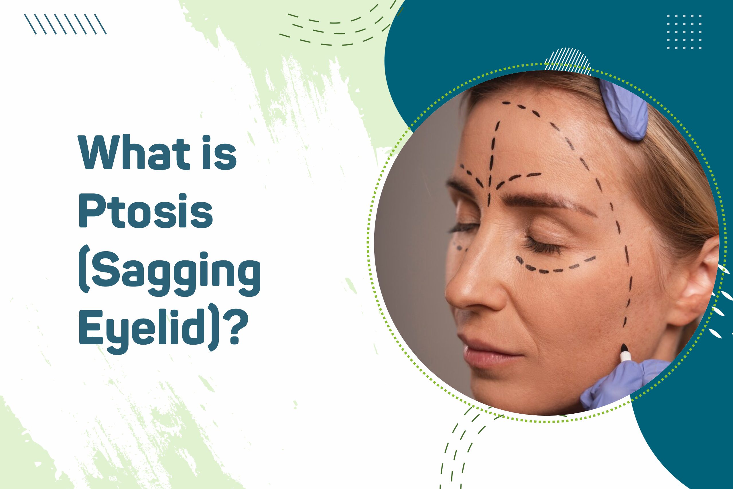 Ptosis (Sagging Eyelid): Causes & Treatment